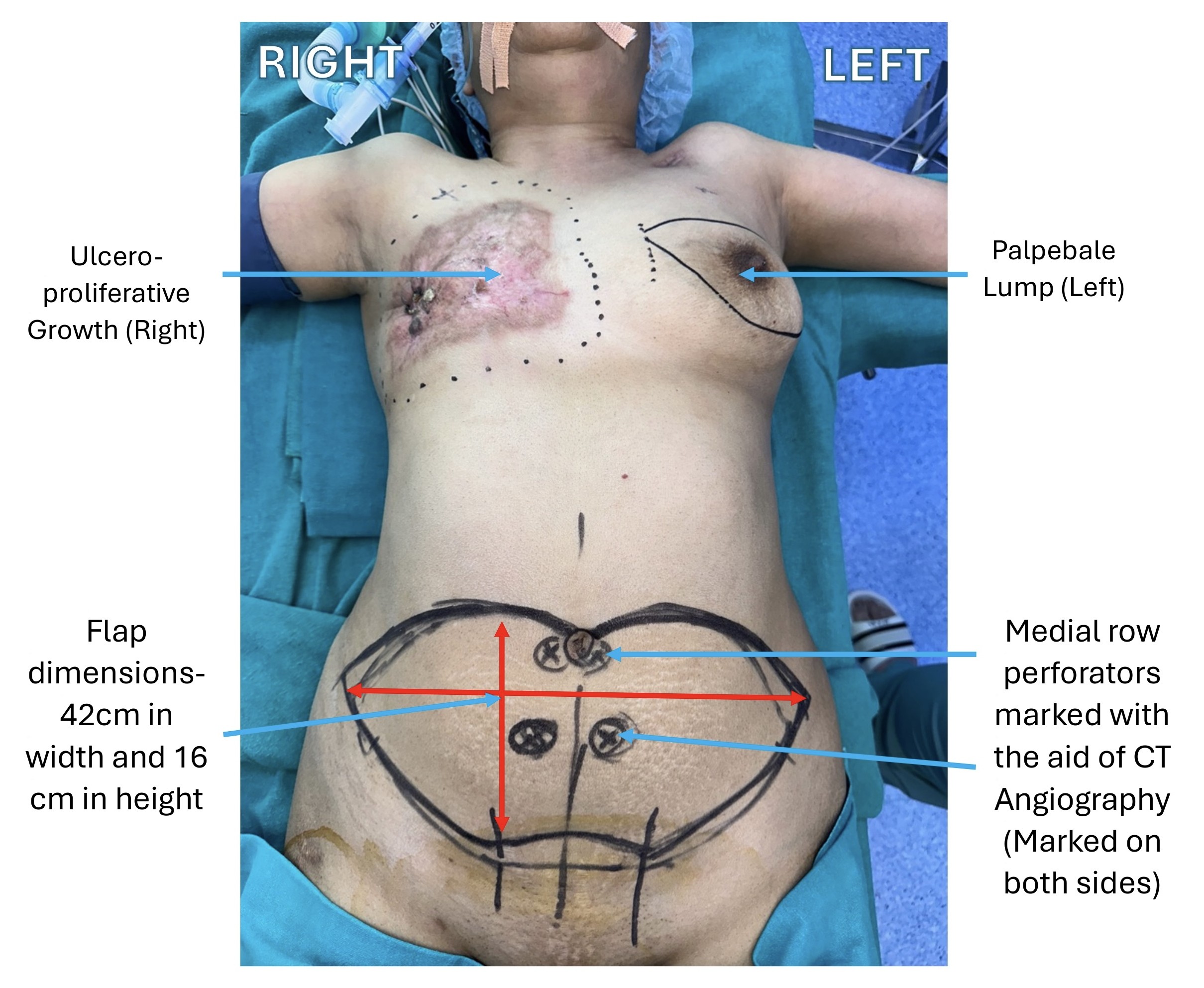 Reconstruction Of Massive Chest Wall Defect After Bilateral Mastectomy
